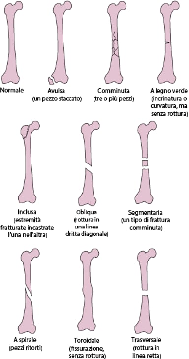 Image:Alcuni tipi di fratture-Manuale MSD, versione per i pazienti