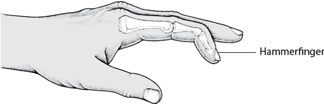 Kurzinformationen:Hammerfinger - MSD Manual Ausgabe für Patienten