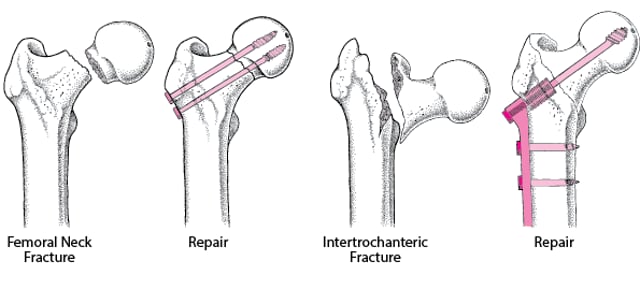 Hip Fractures - Injuries and Poisoning - Merck Manual Consumer Version