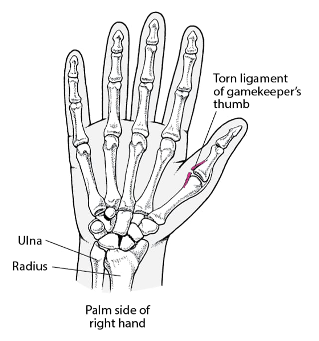 Thumb Sprains - Injuries and Poisoning - MSD Manual Consumer Version