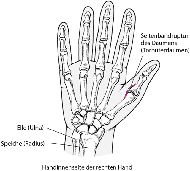 Verstauchungen des Daumens - Verletzungen und Vergiftung - MSD Manual ...