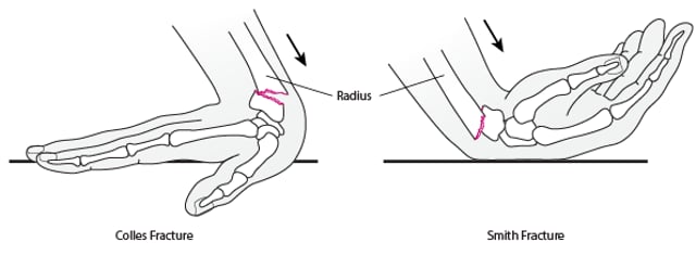 Wrist Fractures - Wrist Fractures - MSD Manual Consumer Version