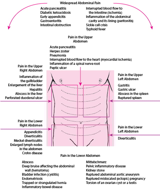 Acute Abdominal Pain - Acute Abdominal Pain - MSD Manual Consumer Version
