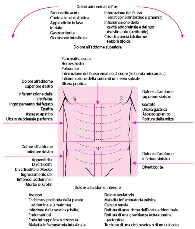 Dolore addominale acuto - Dolore addominale acuto - Manuale MSD ...