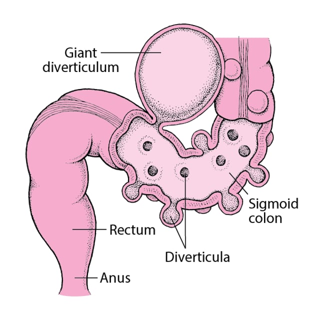 Diverticulosis of the Large Intestine - Digestive Disorders - Merck ...