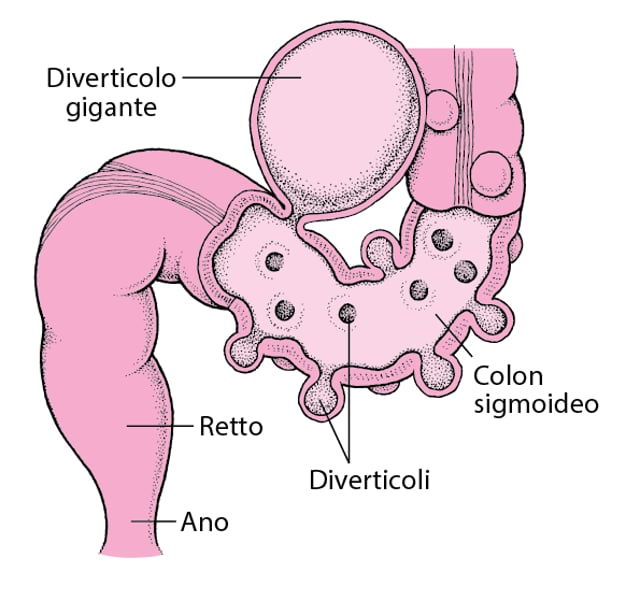 I fatti in Breve:Diverticolite - Manuale MSD, versione per i pazienti