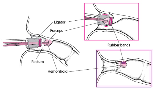 Image:Banding a Hemorrhoid-MSD Manual Consumer Version