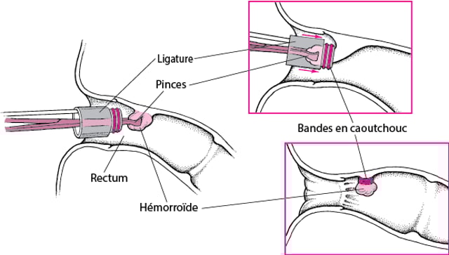 Image:Ligature d’une hémorroïde-Manuels MSD pour le grand public