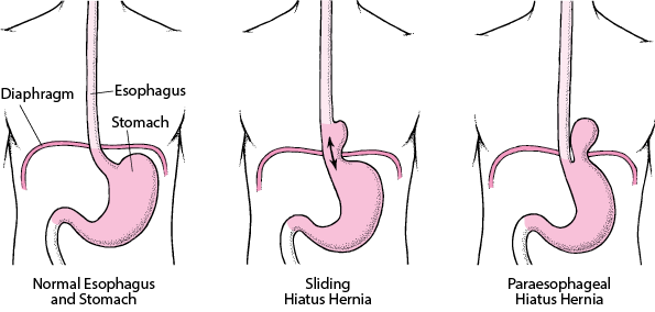 Hiatus (Hiatal) Hernia - Digestive Disorders - MSD Manual Consumer Version