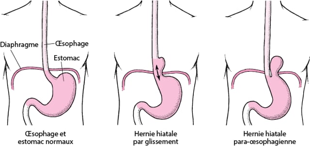 Image:Comprendre la hernie hiatale-Édition professionnelle du Manuel MSD