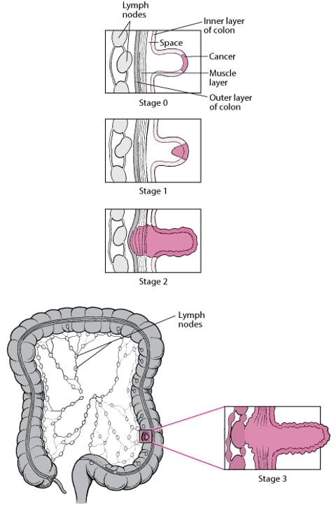 Image:Staging Colon Cancer-Merck Manual Consumer Version