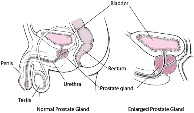 Les faits en bref:Hyperplasie prostatique bénigne (HPB) - Manuels MSD pour le grand public