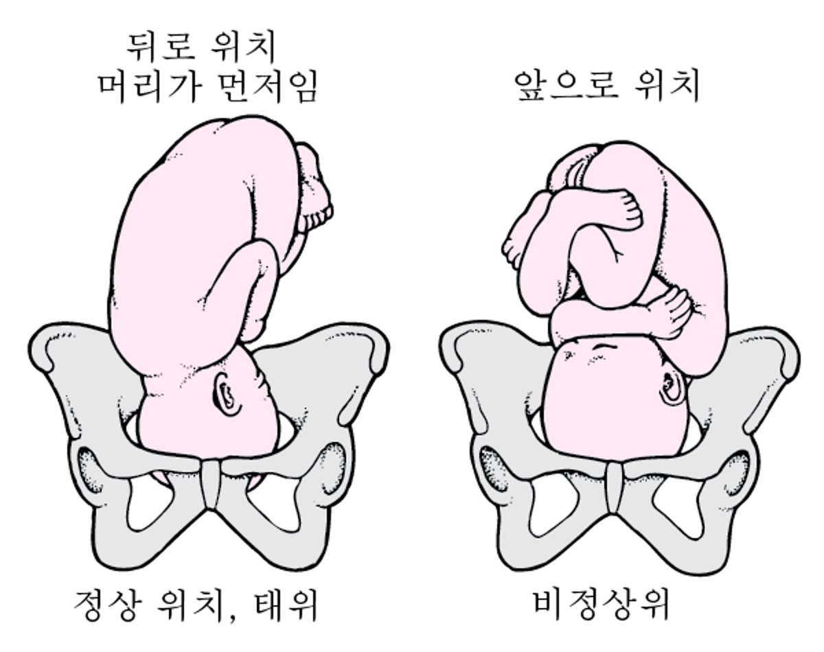신생아의 출산 손상 아동의 건강 문제 Msd 매뉴얼 일반인용