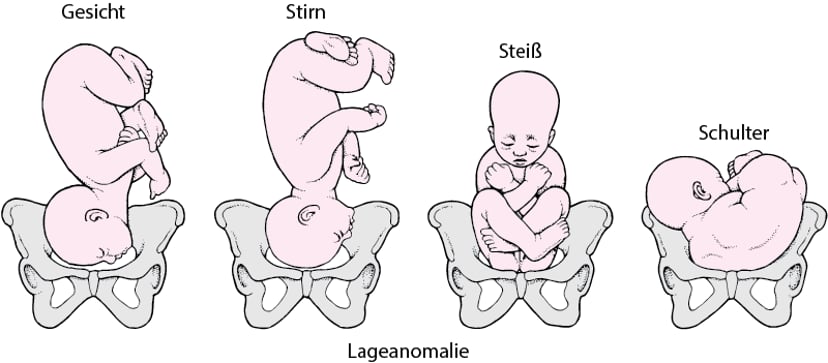 Image:Lage und Haltung des Kindes-MSD Manual Ausgabe für Patienten