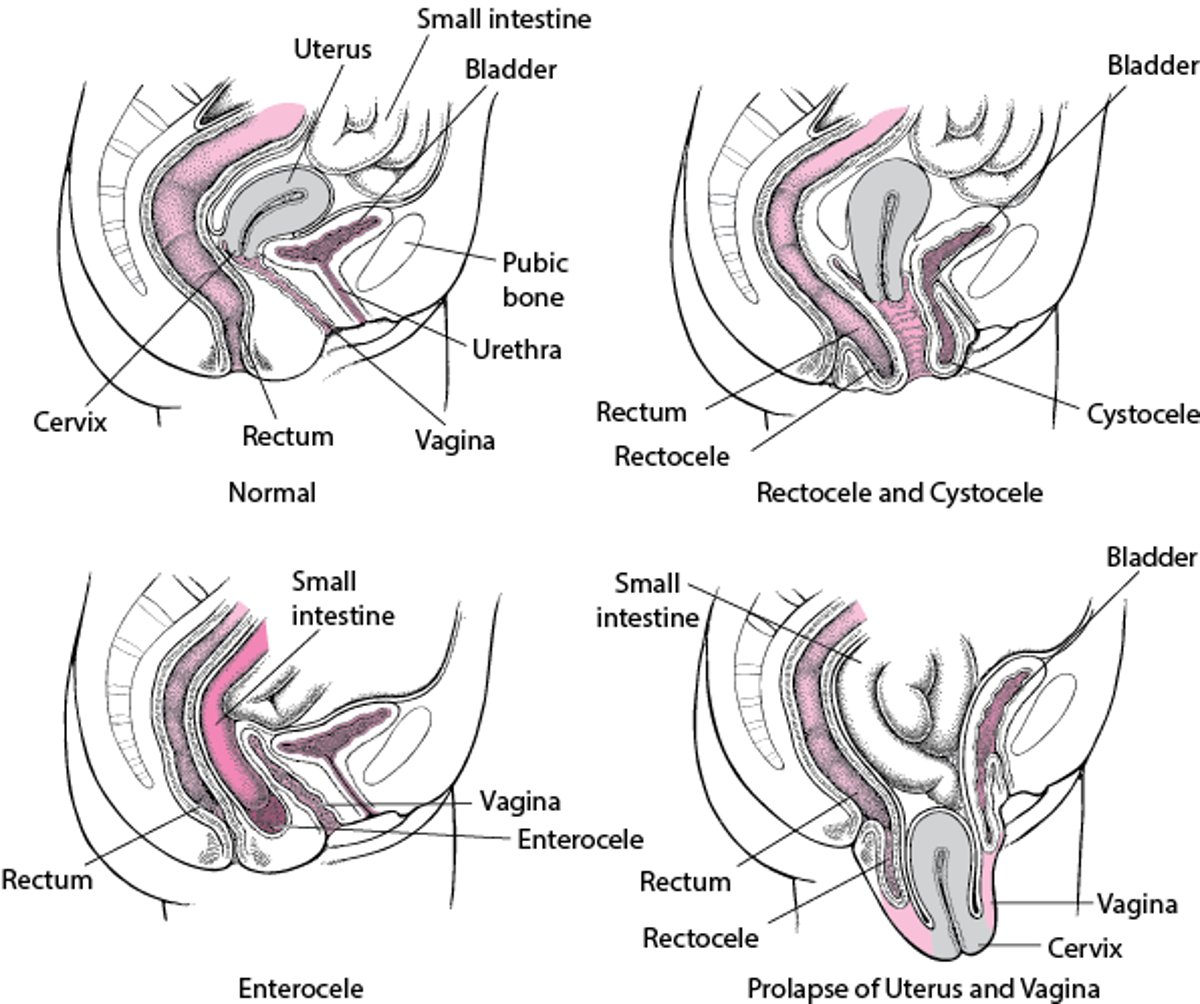 Pelvic Organ Prolapse Pop Womens Health Issues Msd Manual Consumer Version