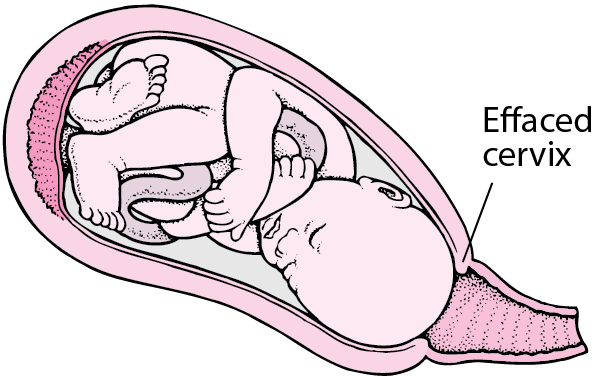 Labor - Women's Health - MSD Manual Consumer Version