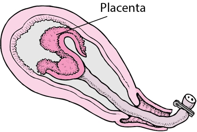 Trabajo de parto - Salud femenina - Manual MSD versión para público general