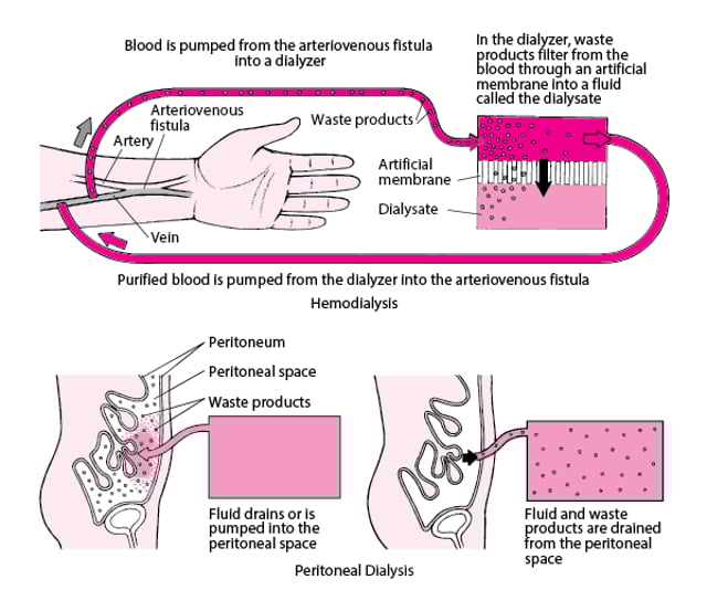 Dialysis - Kidney and Urinary Tract Disorders - MSD Manual Consumer Version