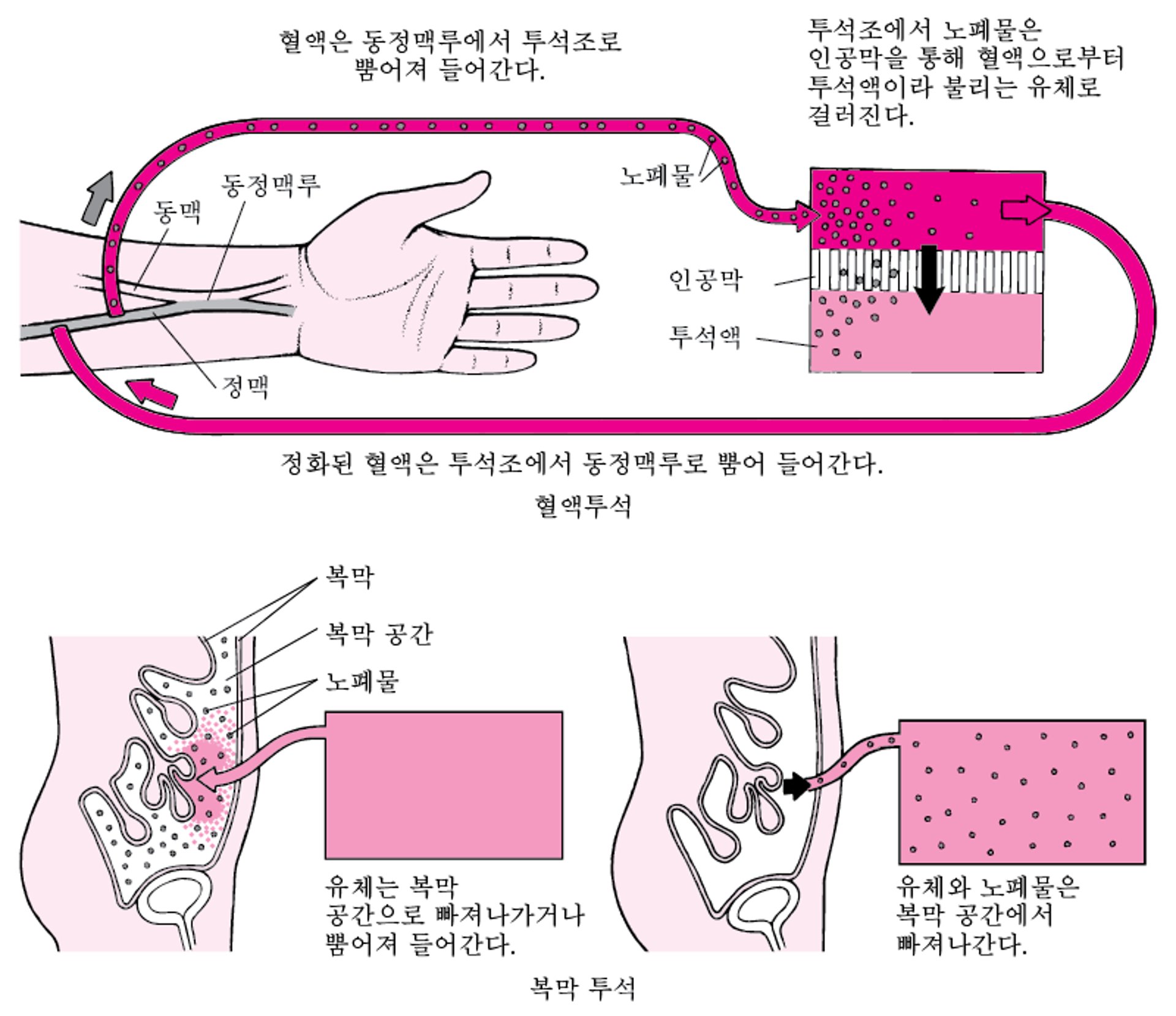 투석 투석 Msd 매뉴얼 일반인용