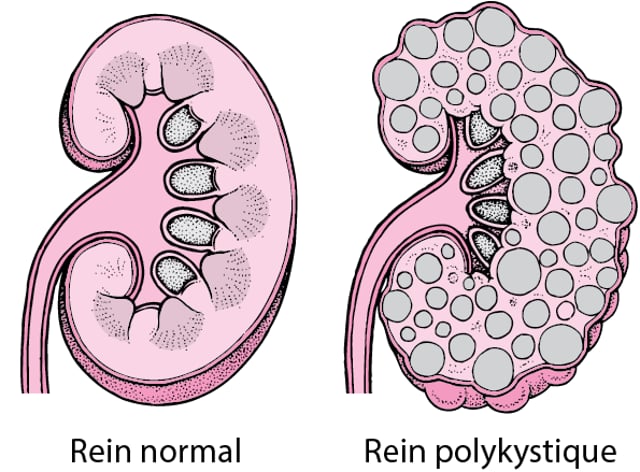 Polykystose rénale (PKR) - Troubles rénaux et des voies urinaires ...