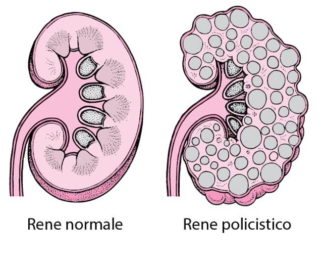 Difetti renali - Difetti renali - Manuale MSD, versione per i pazienti