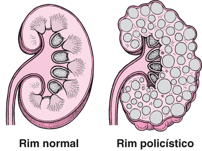 Doença renal policística (DRP) - Distúrbios renais e urinários - Manual ...
