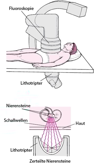 Steine im Harnweg - Steine im Harnweg - MSD Manual Ausgabe für Patienten