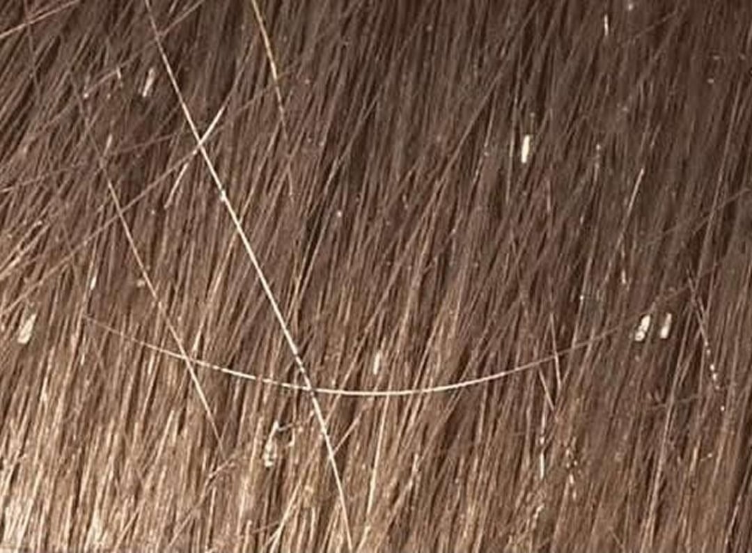 Quick Facts:Lice - Merck Manual Consumer Version