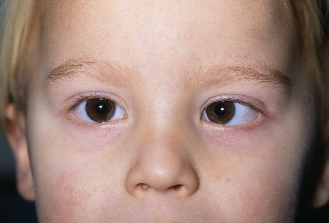 Image:Strabismus (Esotropia)-Merck Manual Consumer Version