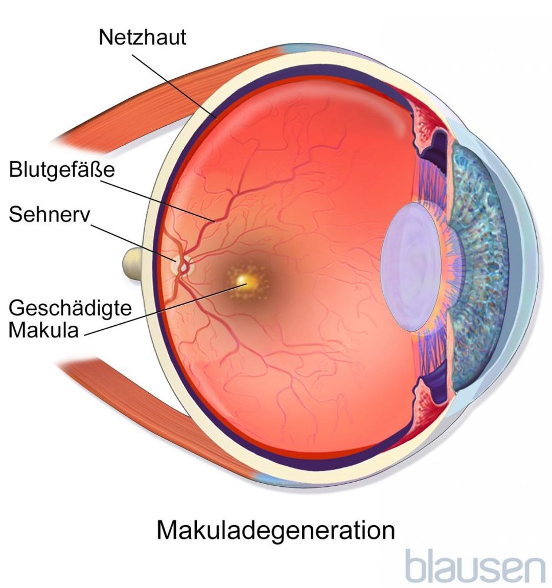 Altersbedingte Makuladegeneration (AMD) - Augenkrankheiten - MSD Manual ...