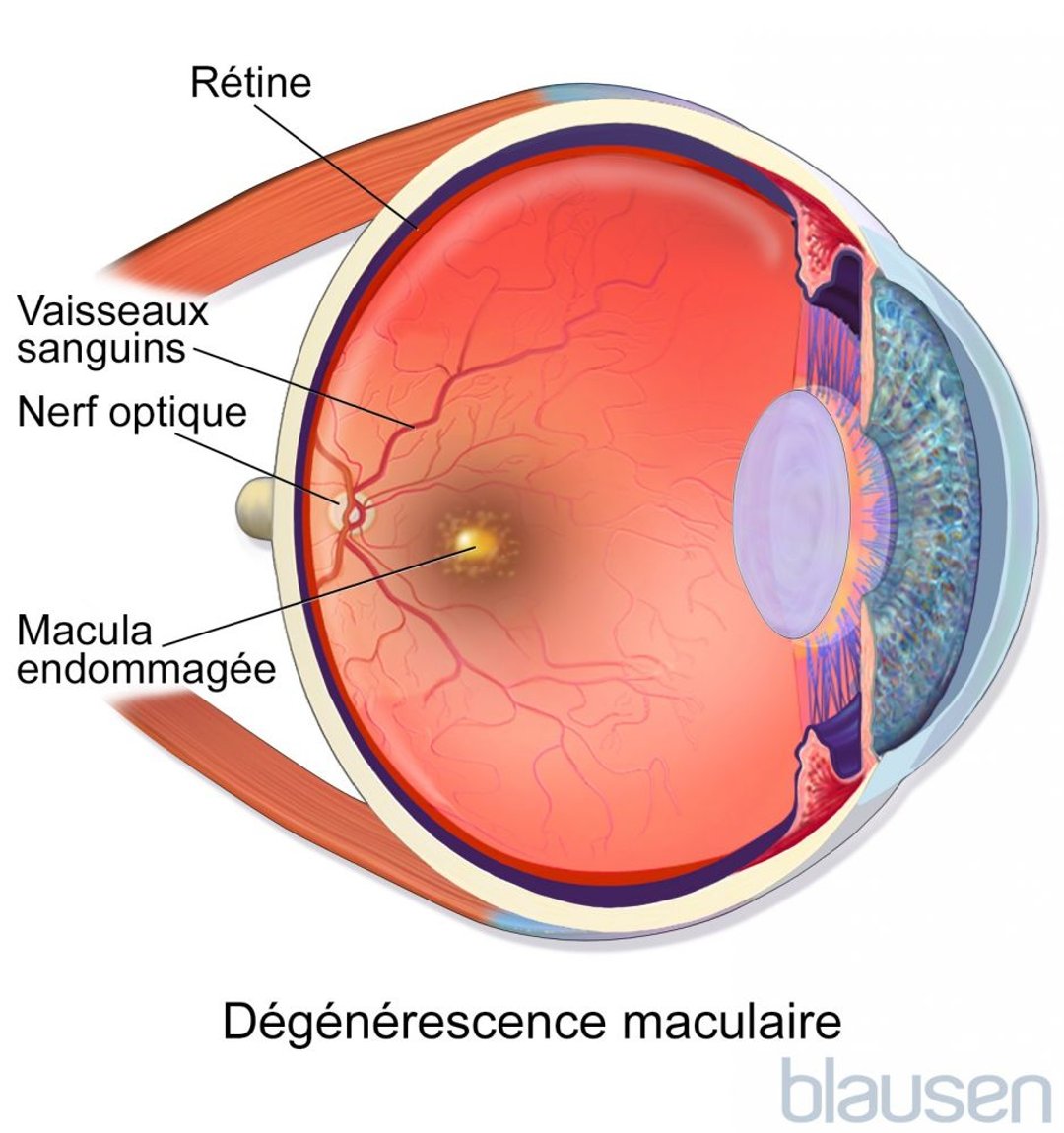Dégénérescence maculaire liée à l’âge (DMLA) - Dégénérescence maculaire ...