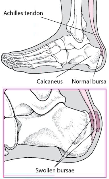 Image:Bursitis in the Heel-MSD Manual Consumer Version