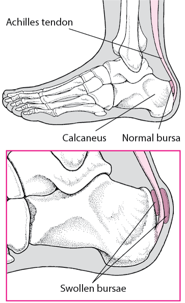 Image:Bursitis in the Heel-MSD Manual Consumer Version