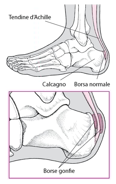 Image:Borsite calcaneare-Manuale MSD, versione per i pazienti