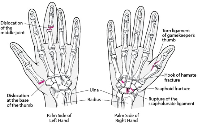 Image:Common Hand Injuries-Merck Manual Consumer Version