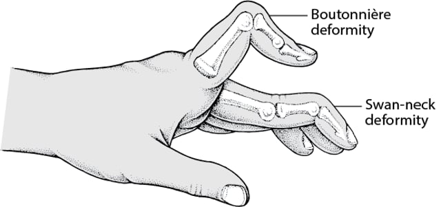 Swan-Neck Deformity - Bone, Joint, and Muscle Disorders - Merck Manual ...