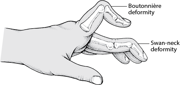 Swan-Neck Deformity - Bone, Joint, and Muscle Disorders - MSD Manual ...