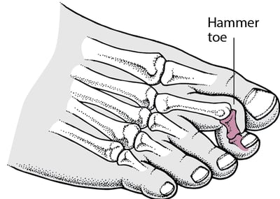 Table: What Is Hammer Toe?-MSD Manual Consumer Version
