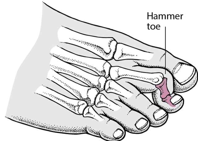 Hammer Toe - Bone, Joint, and Muscle Disorders - MSD Manual Consumer ...