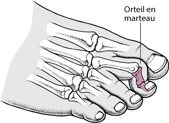 Orteil en marteau - Orteil en marteau - Manuels MSD pour le grand public