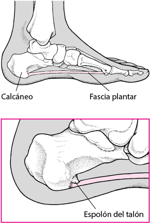 Image:¿Qué es el espolón del talón?-Manual MSD versión para público general