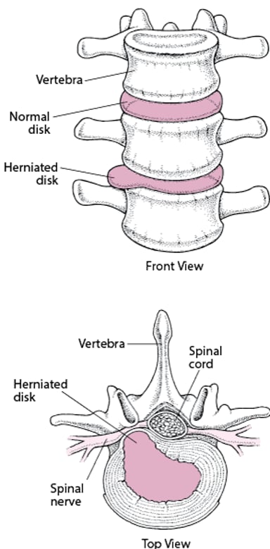 Image:A Herniated Disk-MSD Manual Consumer Version