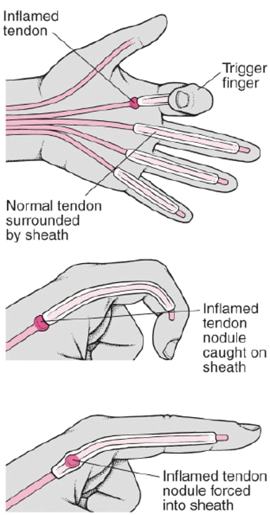 Image:Trigger Finger Position-Merck Manual Consumer Version