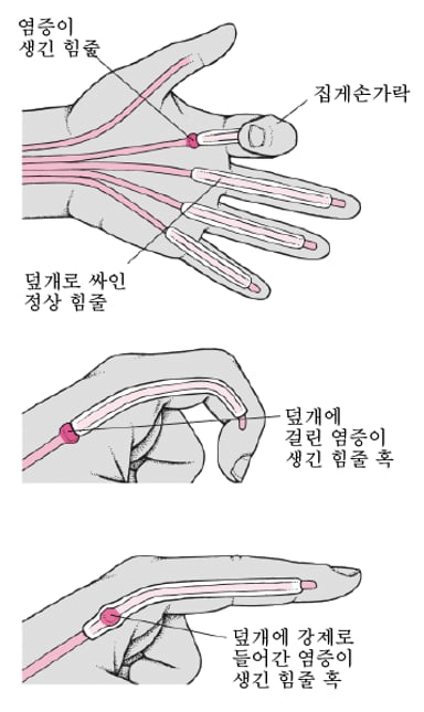 방아쇠 손가락 방아쇠 손가락 Msd 매뉴얼 일반인용