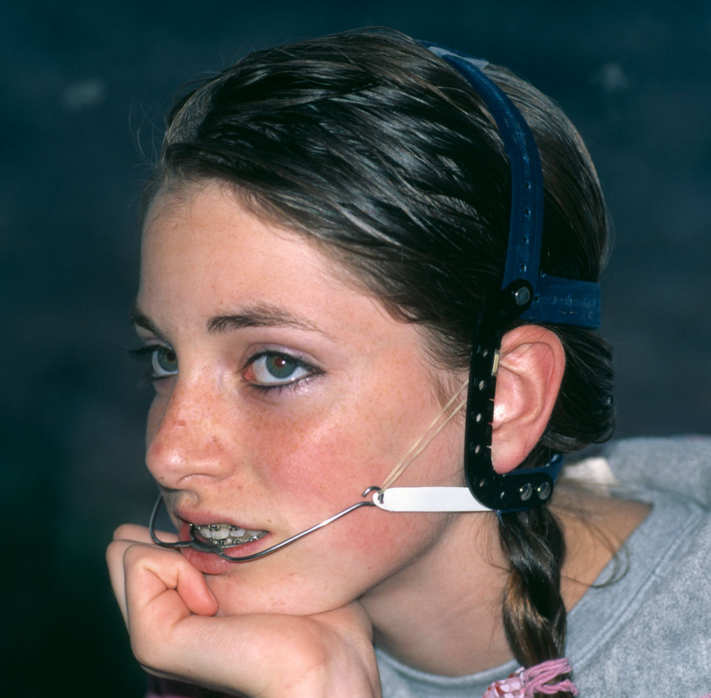 Jaw Defects - Children's Health Issues - MSD Manual Consumer Version