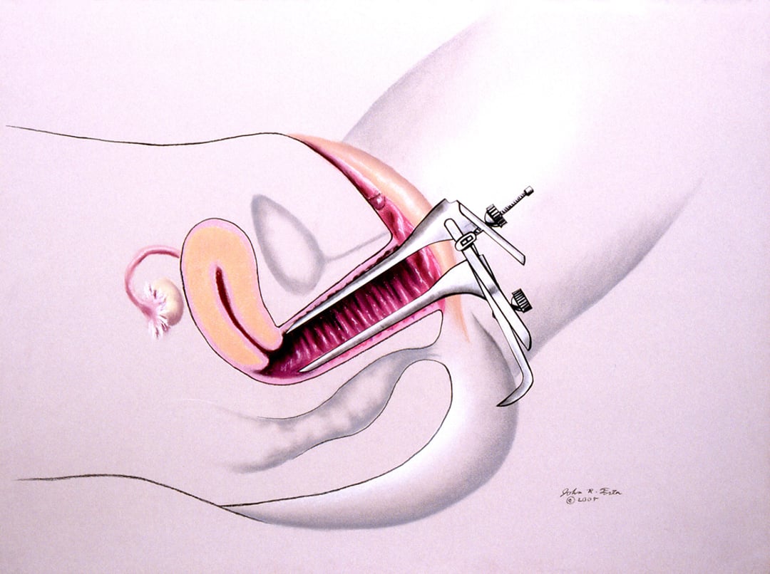 Image Pelvic Examination With Speculum Merck Manual Consumer Version