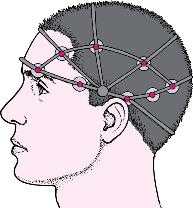 Seizure Disorders - Brain, Spinal Cord, and Nerve Disorders - MSD ...