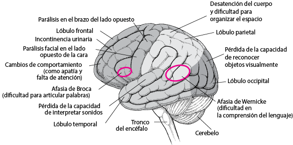 Afasia - Enfermedades cerebrales, medulares y nerviosas - Manuale Merck ...