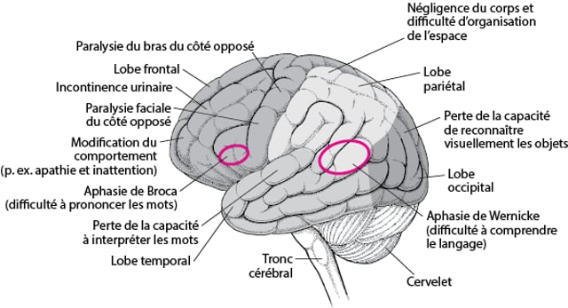 Présentation de l’accident vasculaire cérébral - Troubles du cerveau, de la moelle épinière et ...