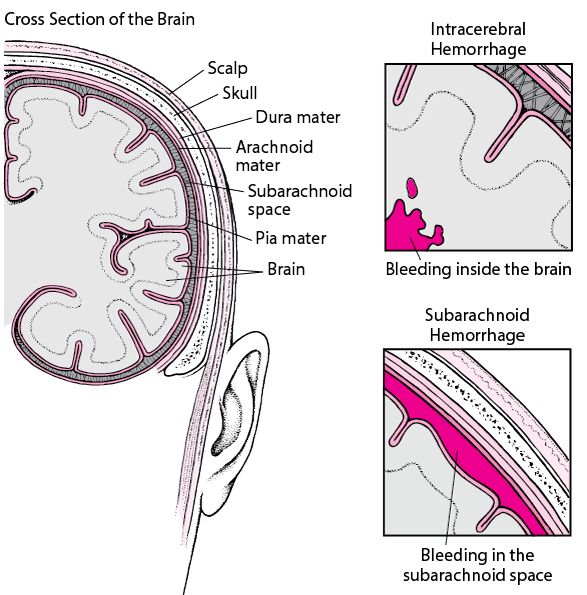 Overview of Hemorrhagic Stroke - Brain, Spinal Cord, and Nerve ...